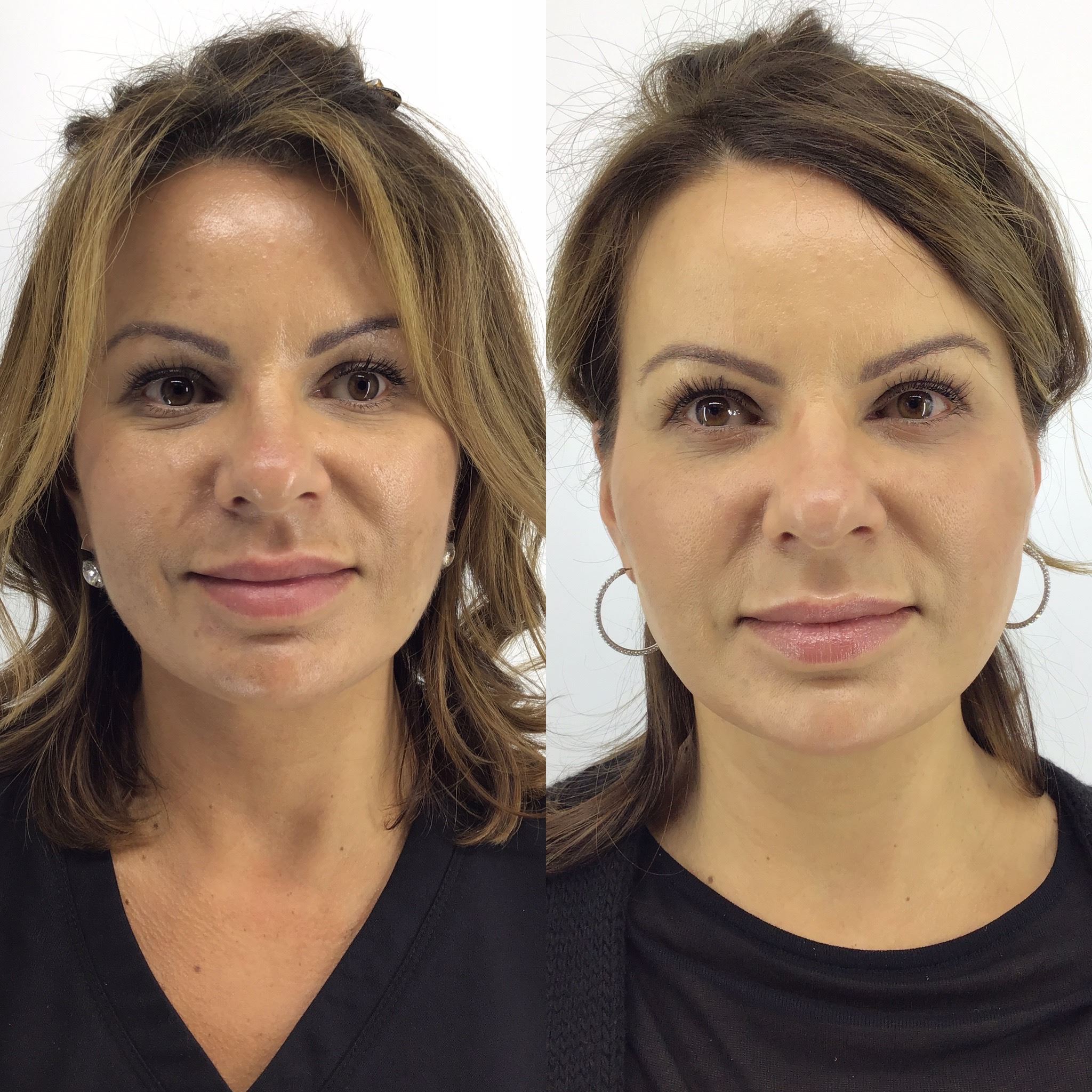 Volure Peel | Volure MedSpa