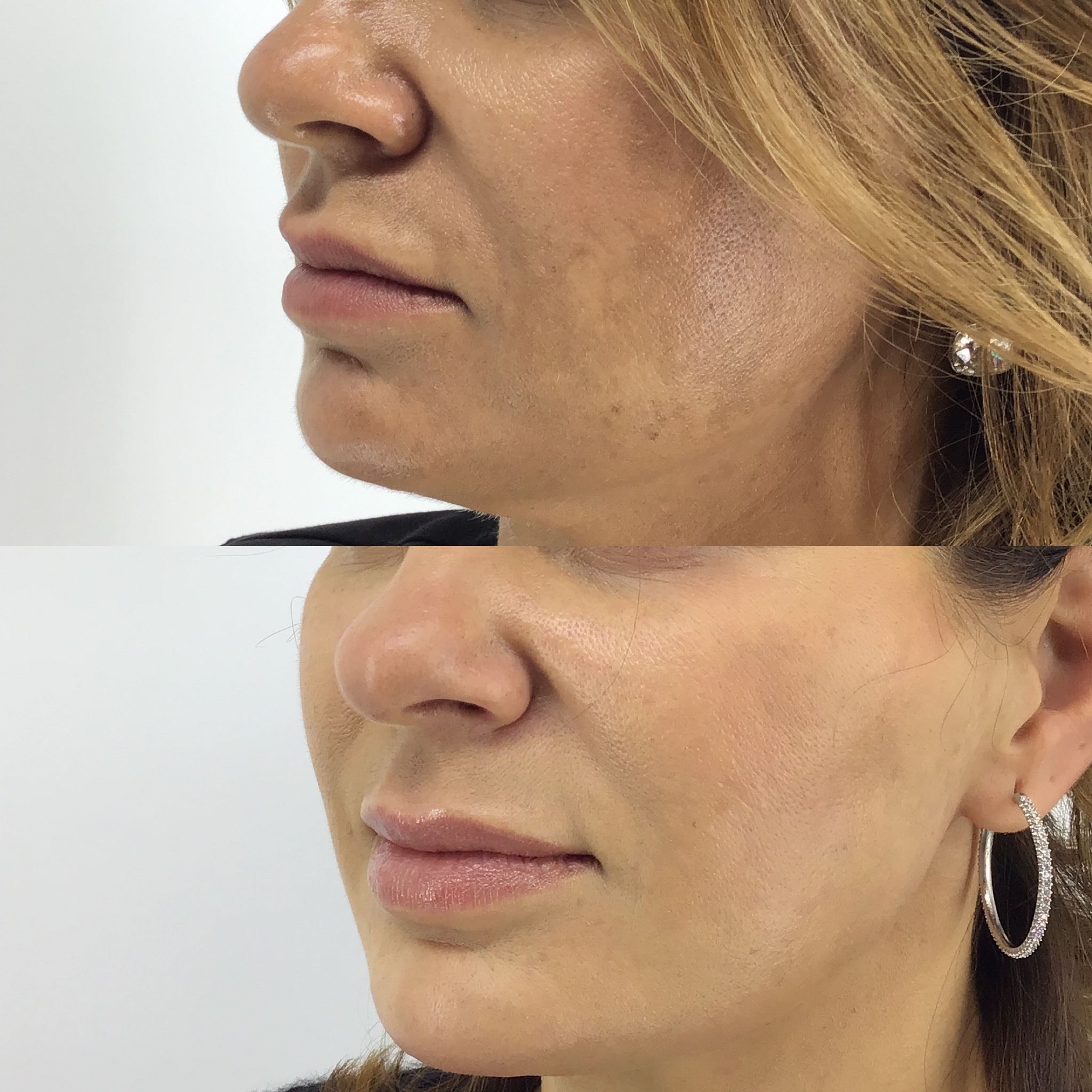 Volure Peel | Volure MedSpa