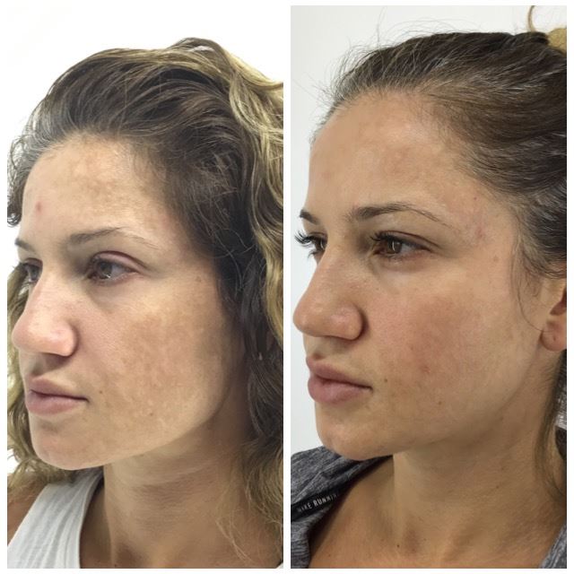 Volure Peel | Volure MedSpa